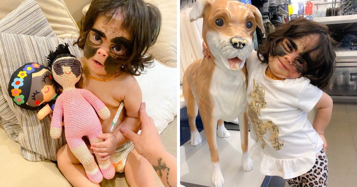 Luna Fenner, la niña que nació con una peculiar marca en su rostro